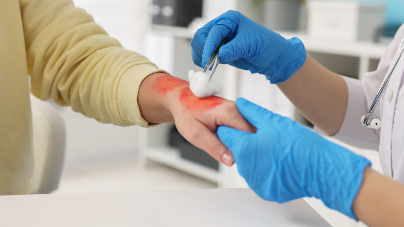 TBSA in Burn Care: What It Is & Why Accurate Measurement Matters