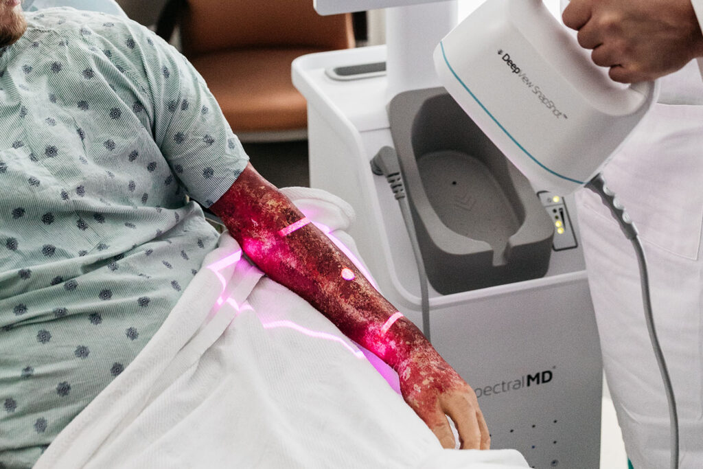 How to Dress a Burn Wound in Clinical Settings - SpectralAI